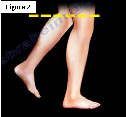 Slap Gait, Steppage Gait, and Foot Drop | HuffPost