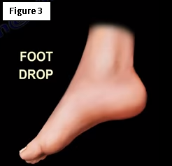 Slap Gait, Steppage Gait, and Foot Drop | HuffPost