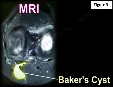What is a Baker's Cyst? | HuffPost