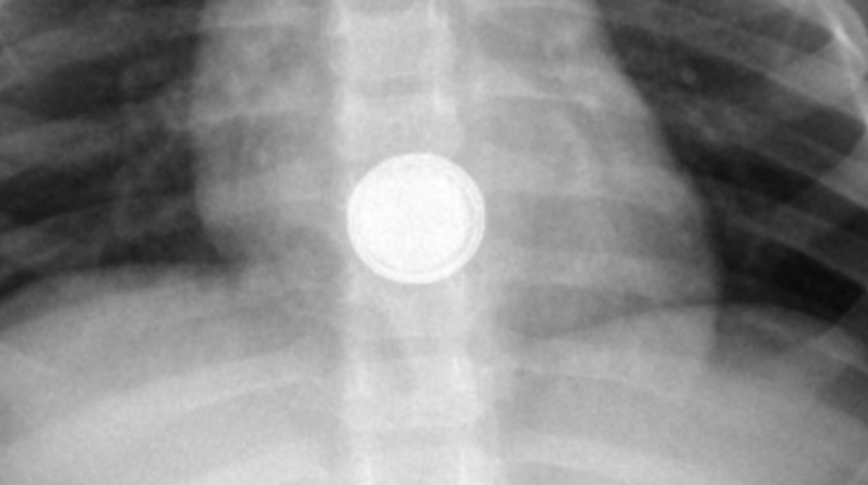 Parents Reminded About Dangers Of Button Batteries After Doctor Removes ...