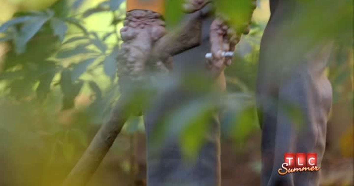 'Bubble Skin Man' Won't Look In Mirror | HuffPost Videos