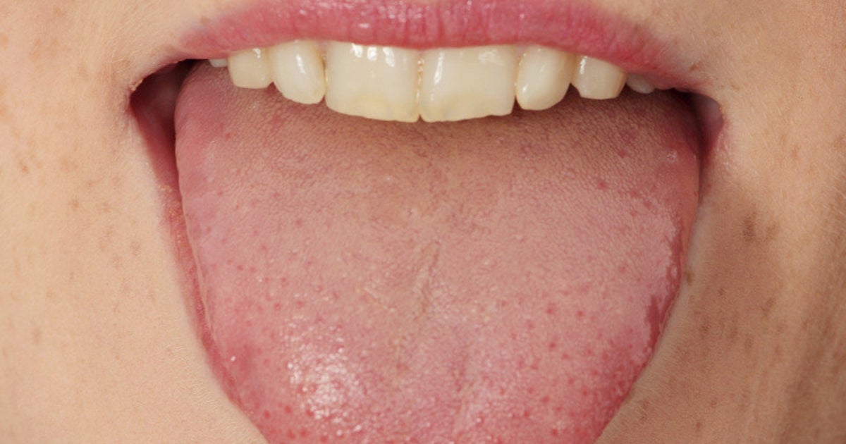 Doctors Tongue Bitten Off After Placing It In Patients Mouth | HuffPost ...