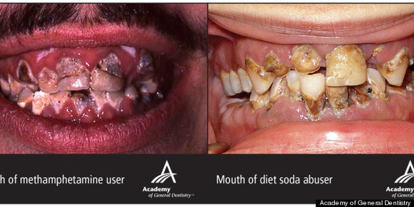 Diet Soda's Effect On Teeth Terrifyingly Similar To Effects Of Meth ...
