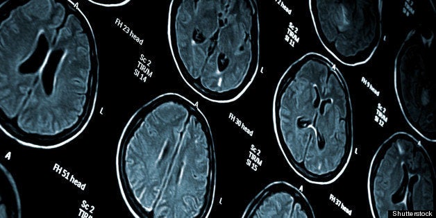 Brain Scan Hints At Best Treatment for Depression | HuffPost Life