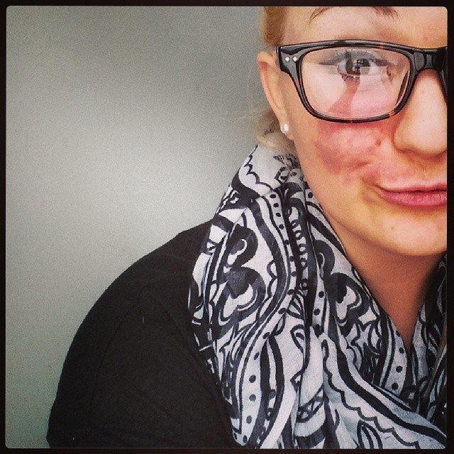 These 19 Stunning Photos Prove That Birthmarks Are Beautiful Huffpost