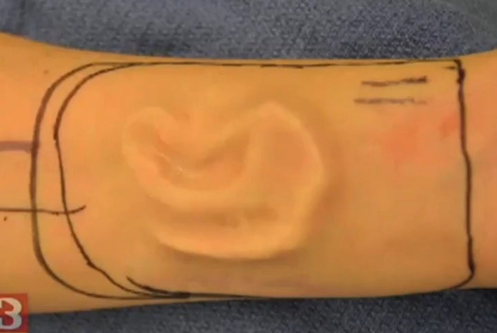 6 Amazing Surgeries That Put Body Parts In The Oddest Places | HuffPost ...