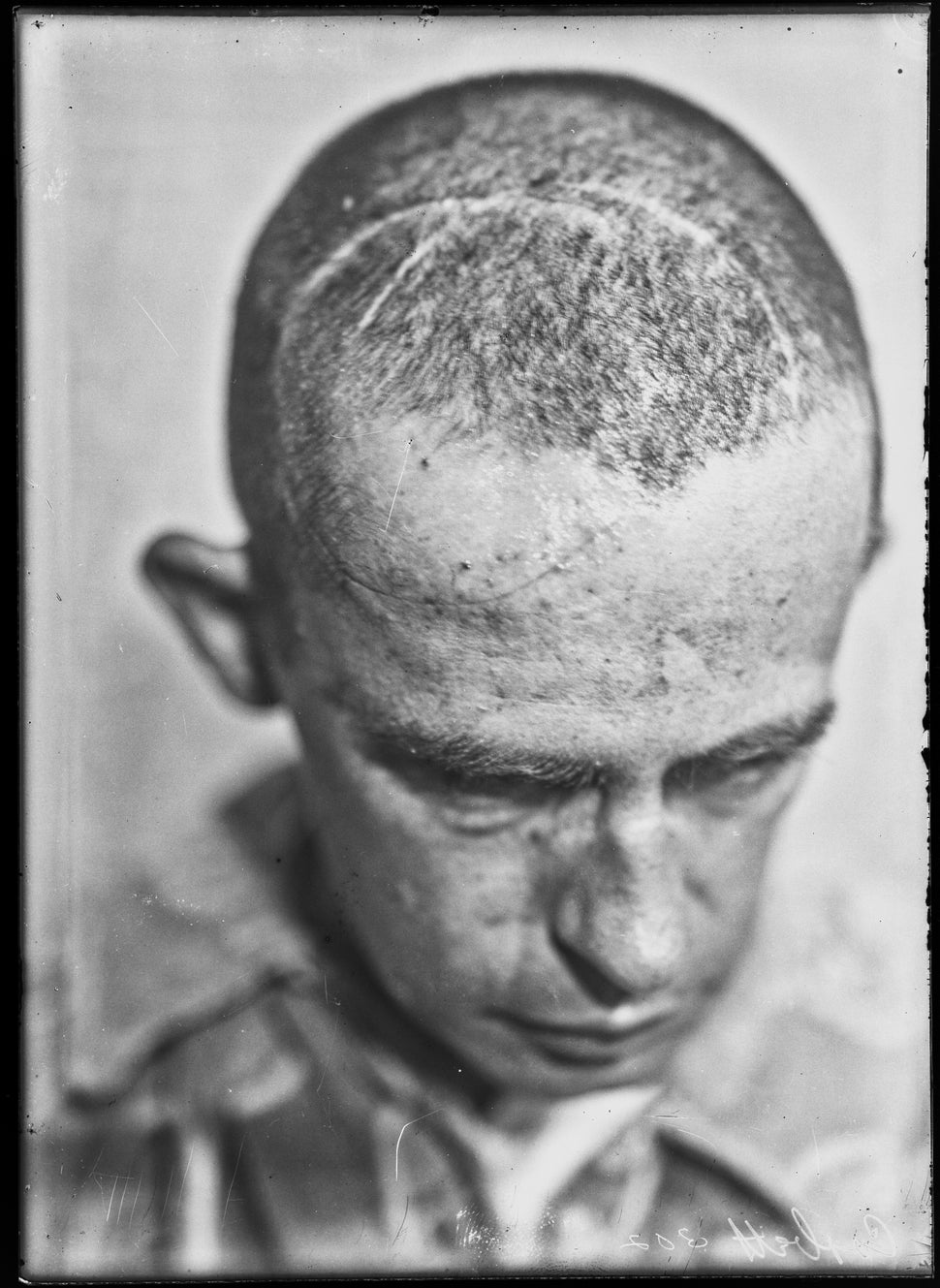 These Haunting Photos Show The Faces Of Brain Surgery Patients In The ...