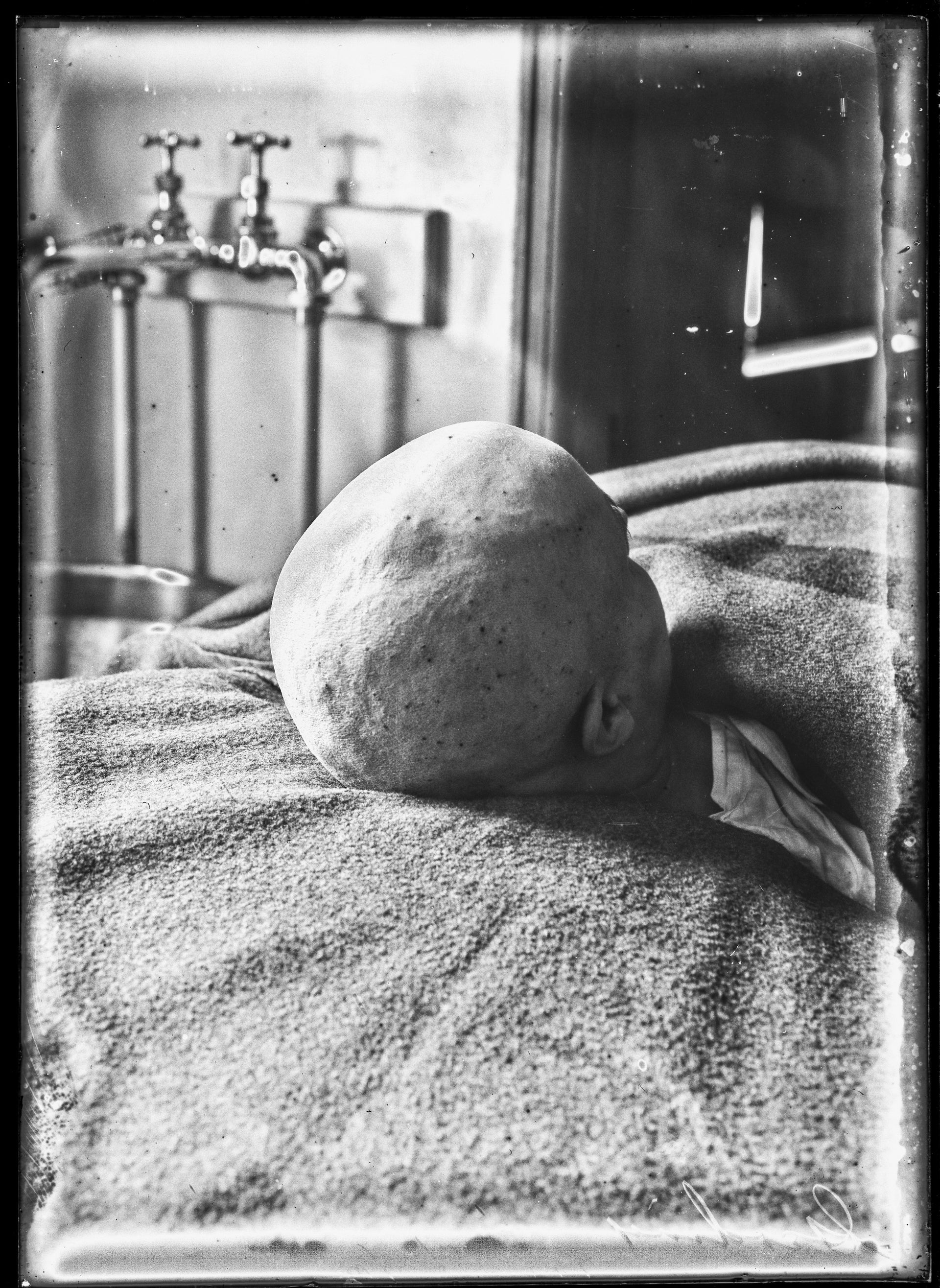 These Haunting Photos Show The Faces Of Brain Surgery Patients In The ...