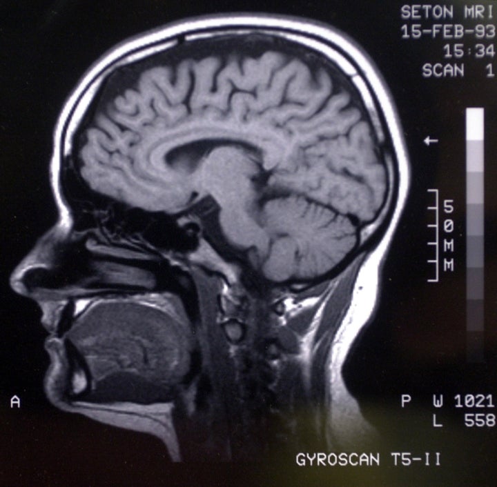Brian Dugan: Brain Scan Used In Murder Trial In Courtroom FIRST ...