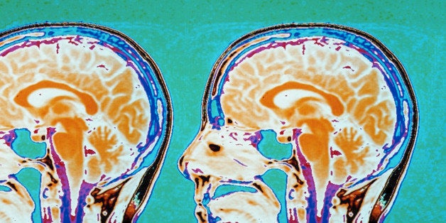 Brain Age Tests To Be Offered To Middle-Aged In Battle Against Dementia ...