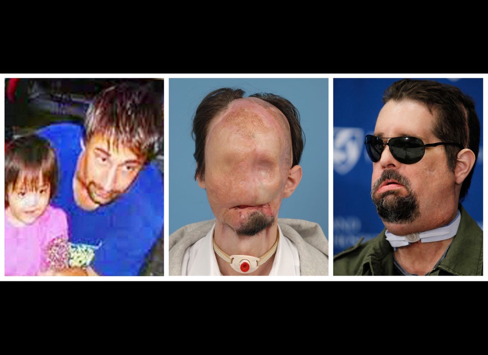 Face Transplant Ucla New Program Replaces Devastated Faces Graphic