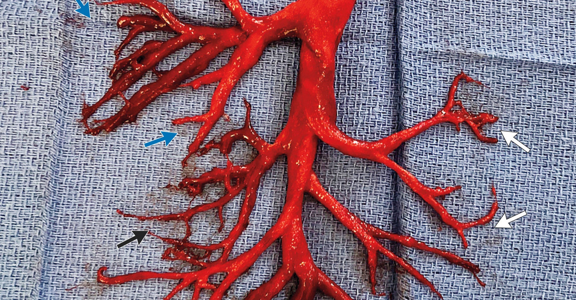 Man Coughed Up Rare Blood Clot That Is The Exact Shape Of Lung Passage ...