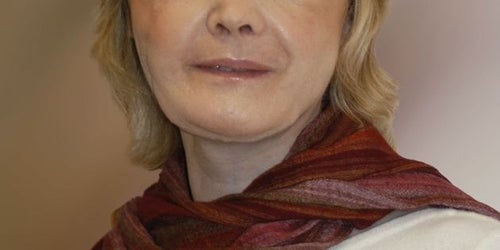 Isabelle Dinoire Before And After Man Shows Off First US Full Face