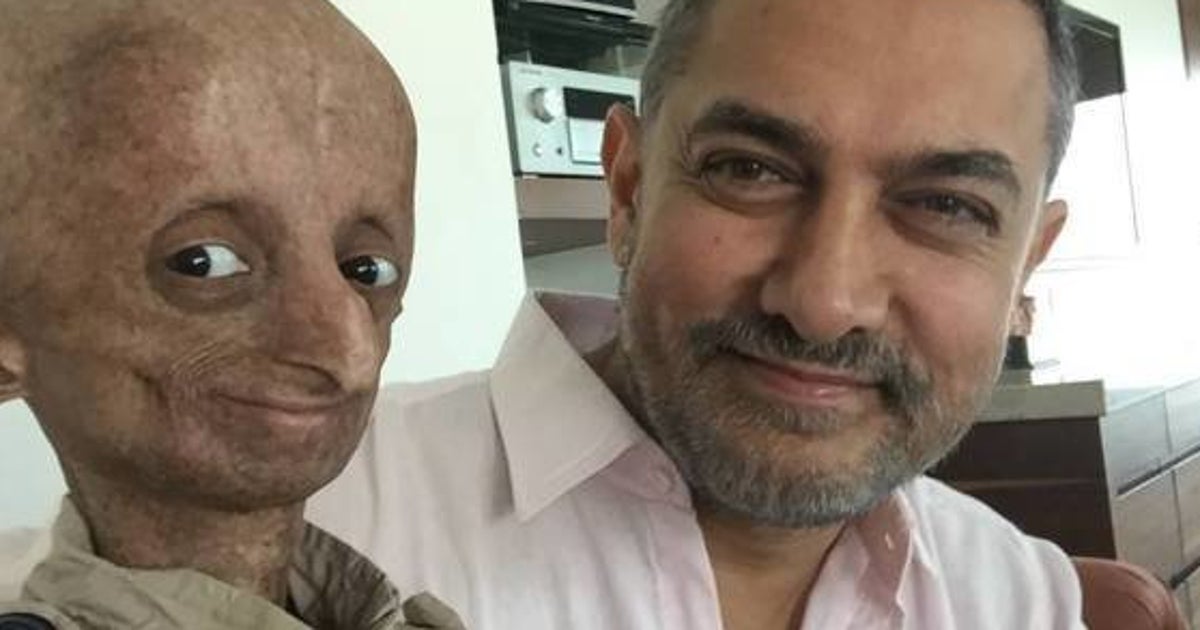 15-Year-Old Nihal Bitla, The Face Of Progeria In India, Passes Away In ...