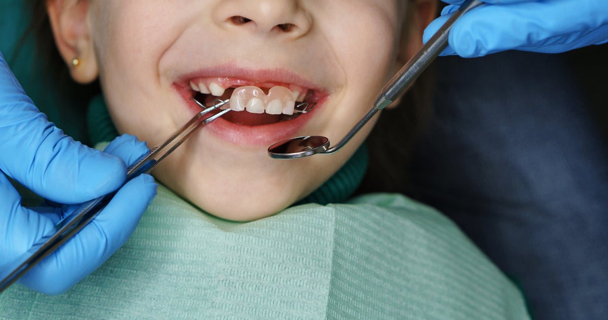 Kids Under Five Are Having Rotting Teeth Extracted – But It's ...