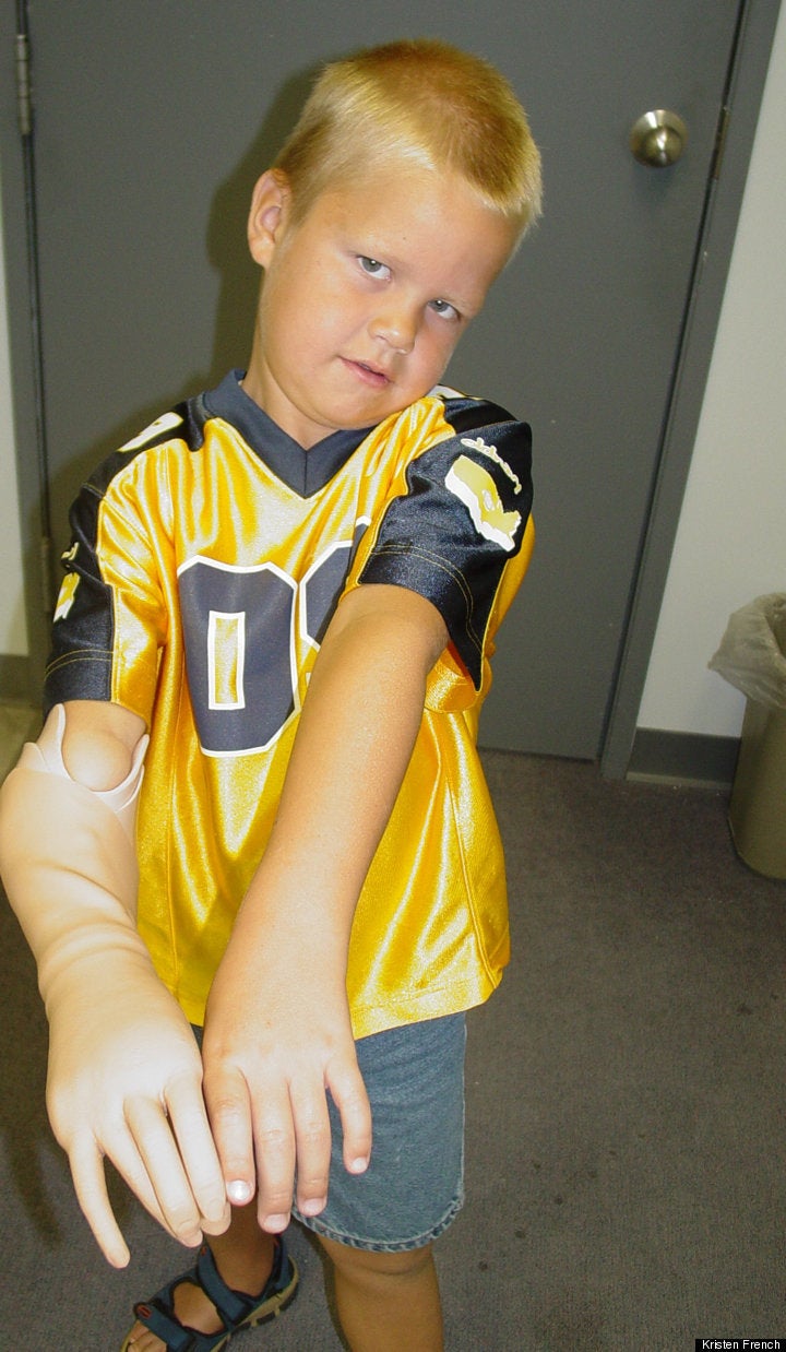 In Reversal, Insurance Plan Will Cover Boy's Prosthetic Arm | HuffPost ...