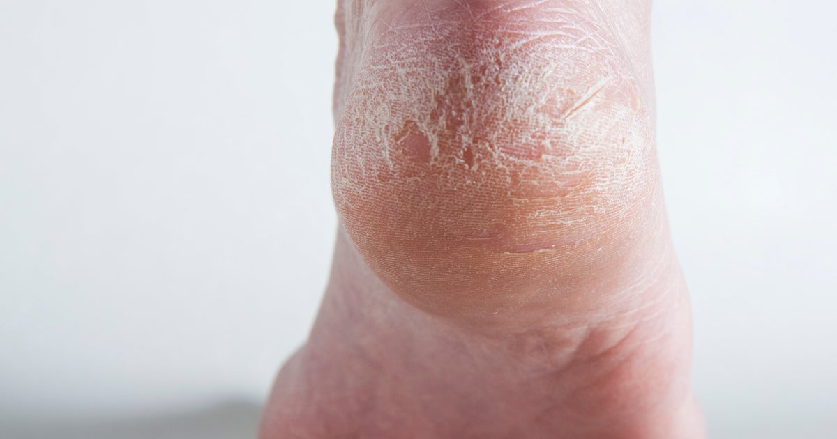 Se débarrasser de la corne aux pieds facilement | HuffPost Vivre