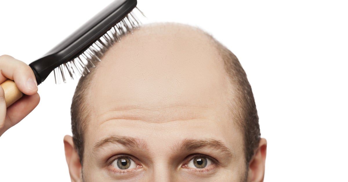I Didn't Tear My Hair Out When I Started Going Bald | HuffPost Life