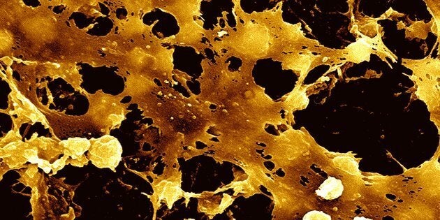 Antibiotic Overuse Means Golden Staph Superbug Is Now More Common