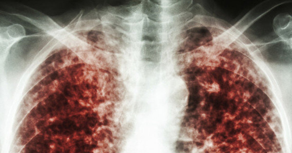 Fighting Tuberculosis Is Everyone's Responsibility | HuffPost Politics