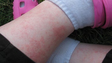 what does heat rash look like