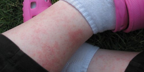 Heat Rash On Child's Legs