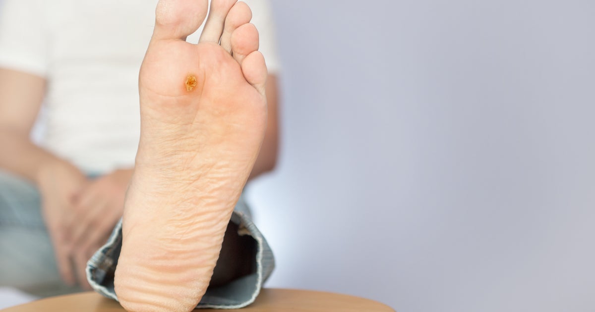 Warts Aren't Just For Witches: Here's What You Should Know About Them ...