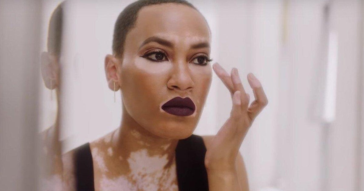 These People On Social Media Are Proud Of Their Vitiligo | HuffPost Style