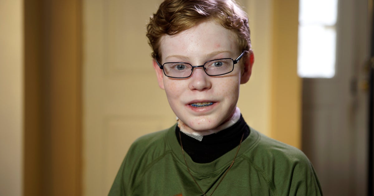 Condolences Pour In For Jonathan Pitre, Ottawa's 'Butterfly Boy ...