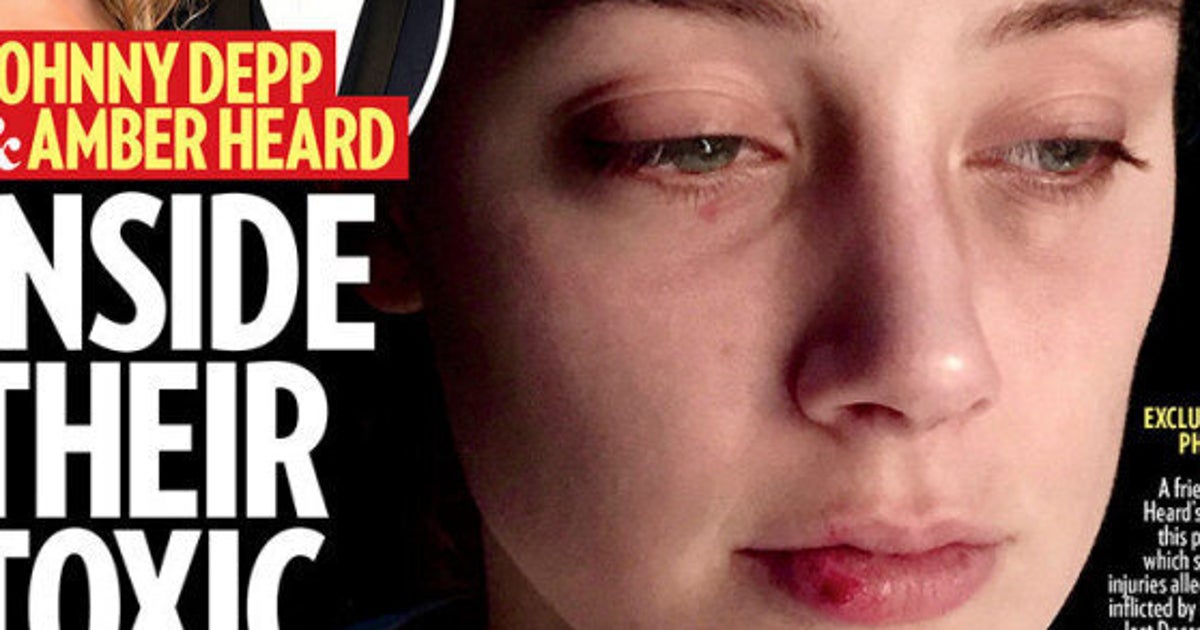 New Amber Heard Photos Show Injuries Allegedly Caused By Johnny Depp Huffpost Life