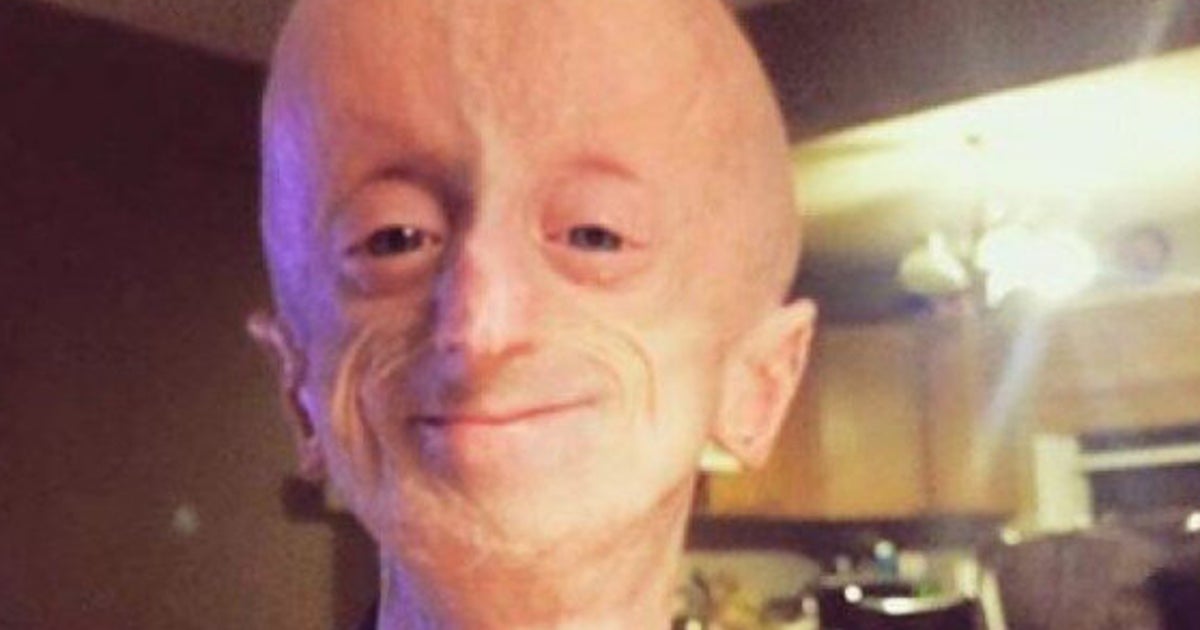 Devin Scullion, Hamilton Man With Rare Aging Disorder, Dies At Age 20 ...