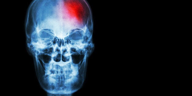 Migraine Sufferers At Higher Risk Of Stroke After Surgery Study Migraine Sufferers At Higher Risk Of Stroke After Surgery Study