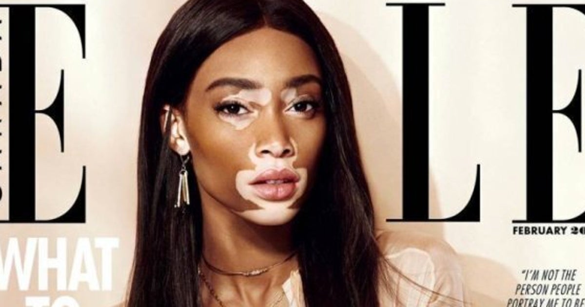Winnie Harlow Opens Up About Being Comfortable In Her Own Skin ...
