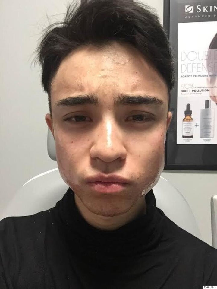 I Survived The Kim Kardashian Vampire Facial Huffpost Style