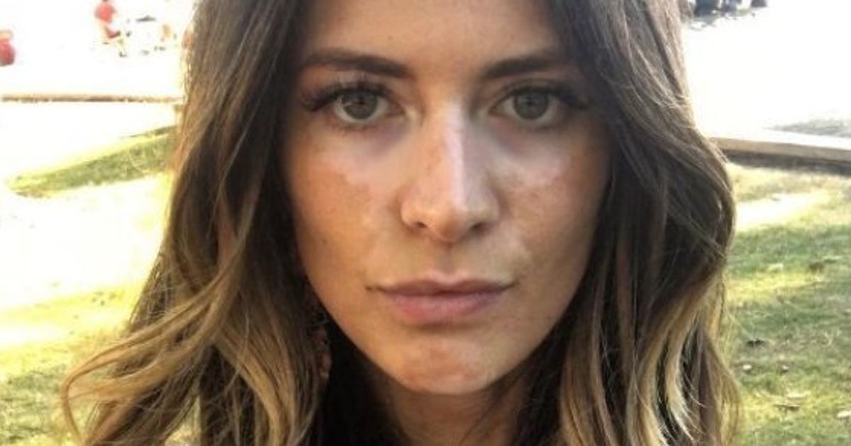 Former 'Bachelor' Contestant Breanne Rice Opens Up About Her Vitiligo ...