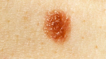 sun exposure skin cancer