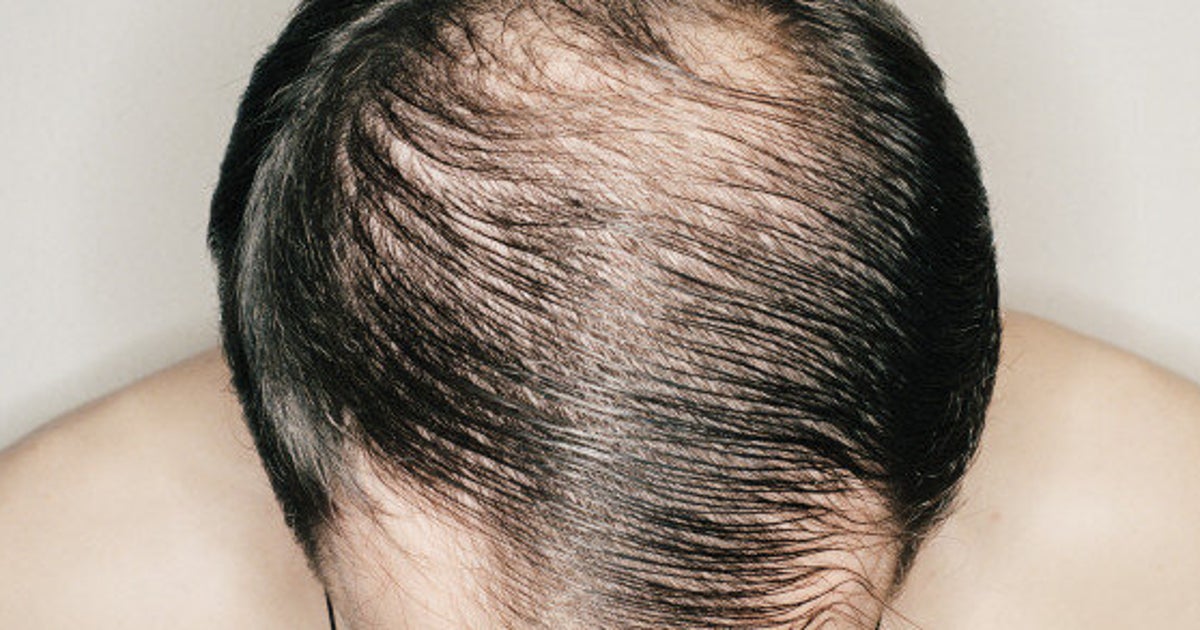 Male Baldness: When Do Men Go Bald? | HuffPost Life