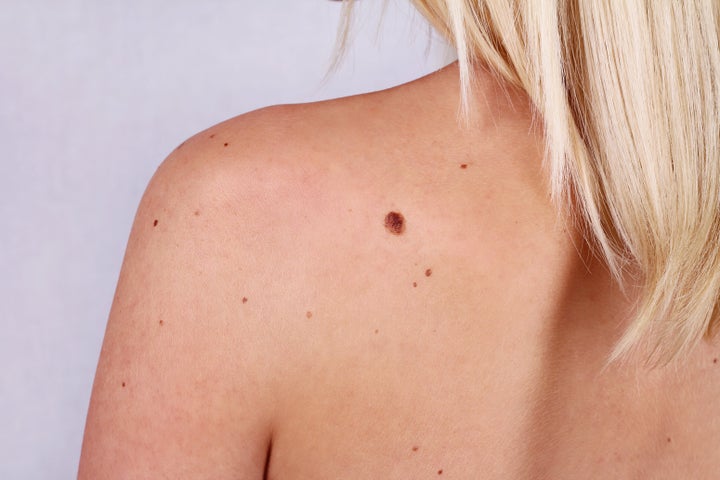 Mélanome Avez Vous Le Cancer De La Peau Huffpost Vivre