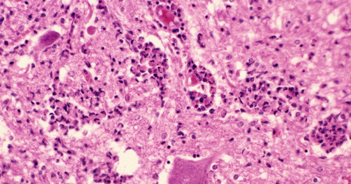 The End Of Polio Is In Sight | HuffPost News