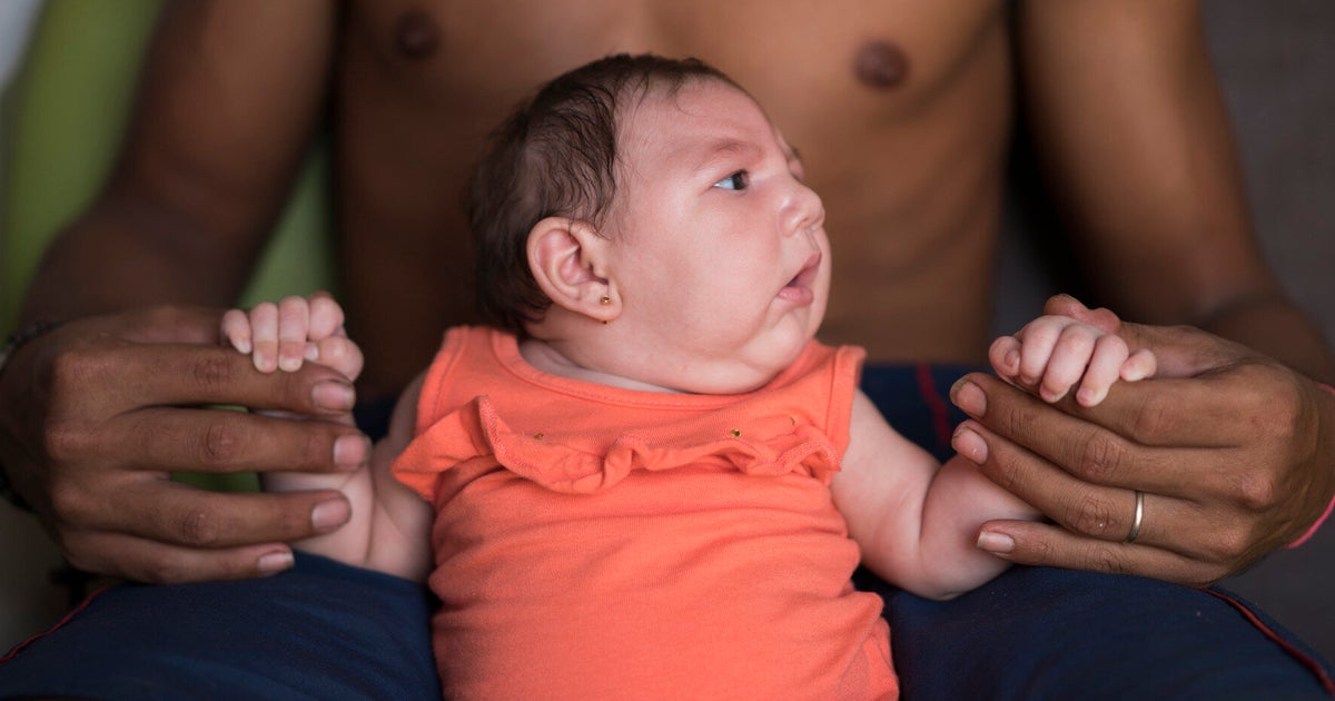 'Shrunken Brain Disease' in Babies Linked to Zika Virus - but There Is ...