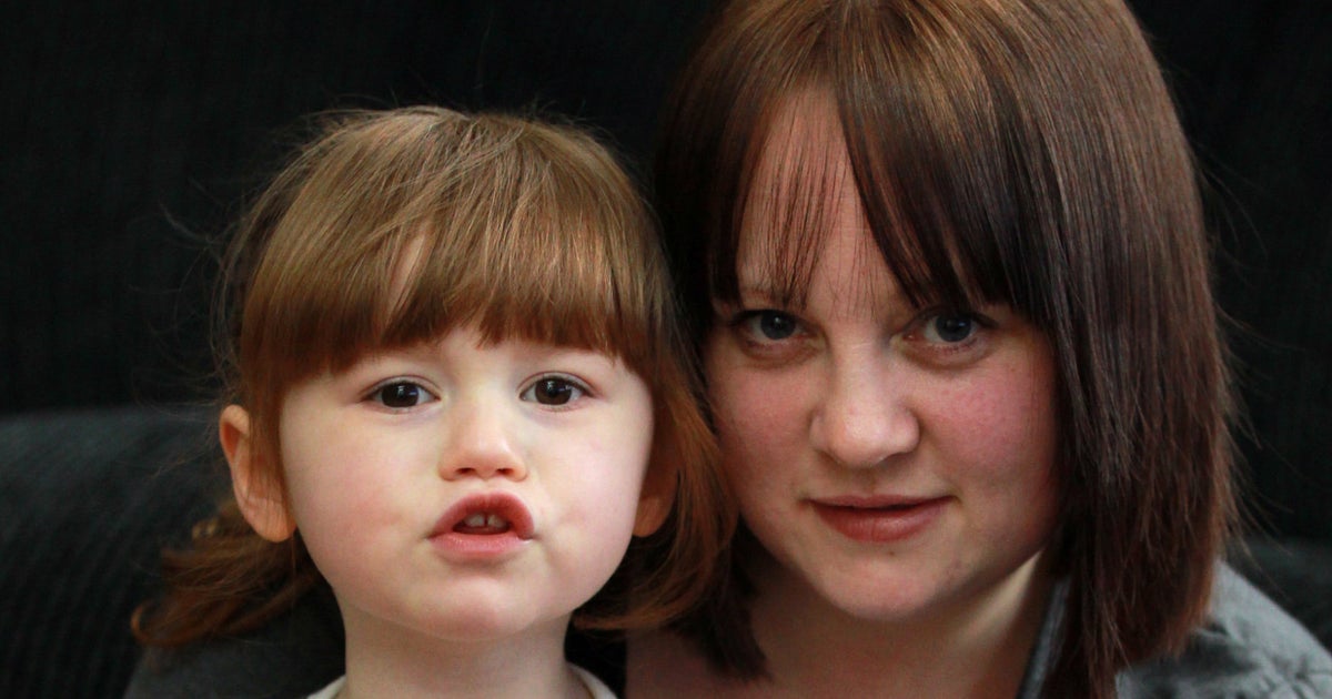 Toddler Swallowed Lithium Battery Which 'Burned Through Lung' And Spent ...