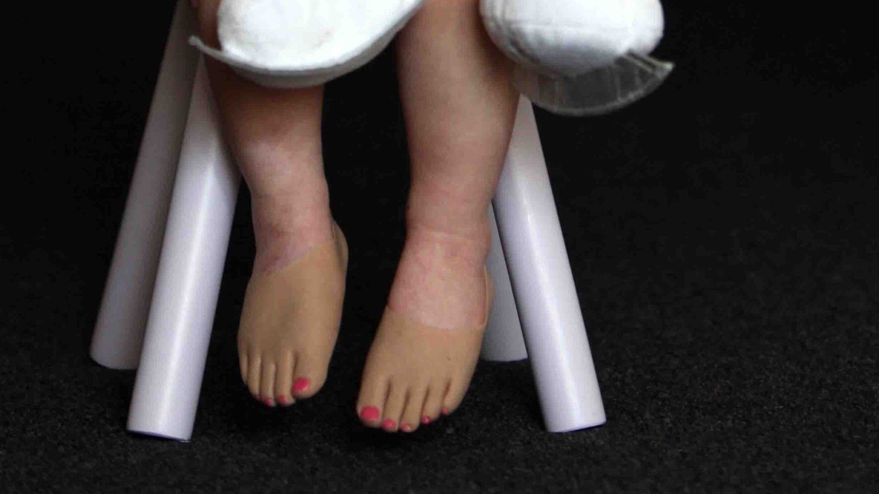 Girl Who Lost Feet To Meningitis Learns To Walk And Dance Again With ...