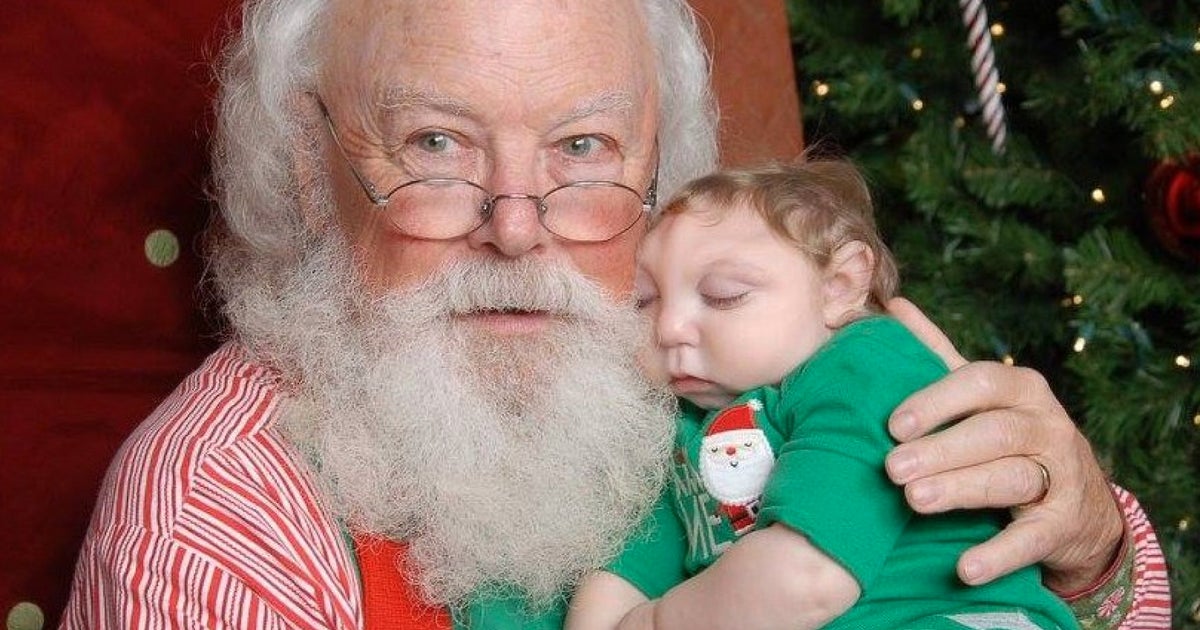 Baby Jaxon Buell Born With Parts Of Skull Missing Meets Santa For The ...