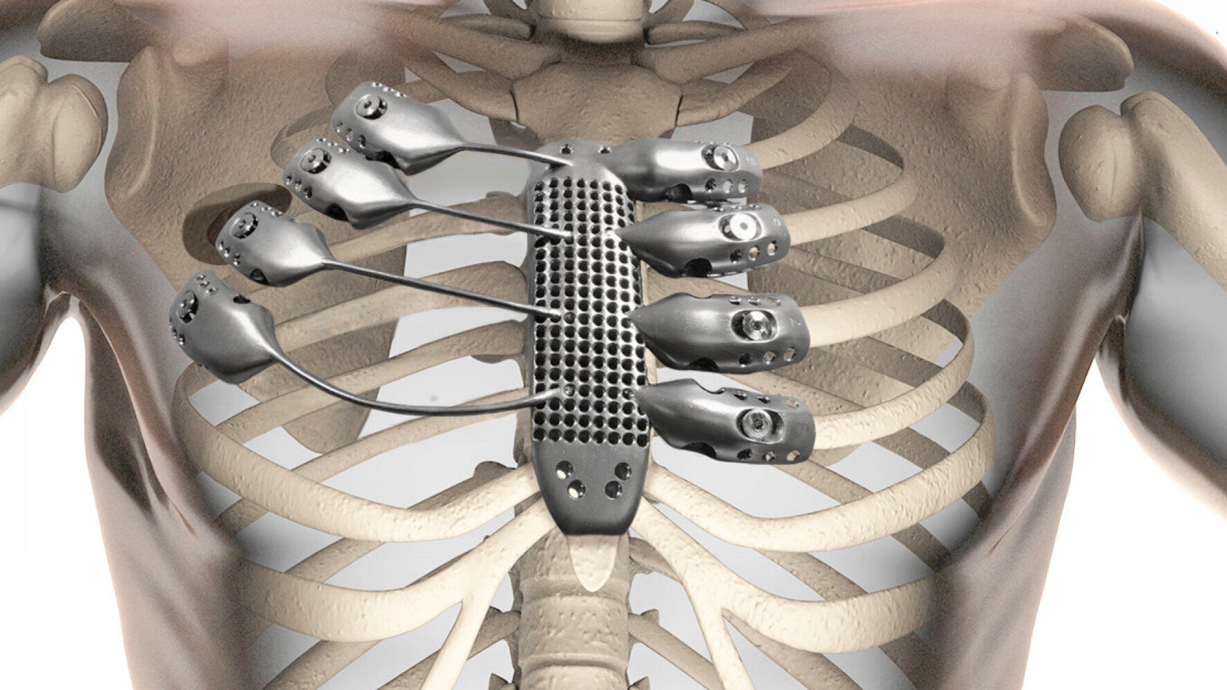 3D-Printed Titanium Rib Cage Designed For Cancer Patient Makes Medical ...