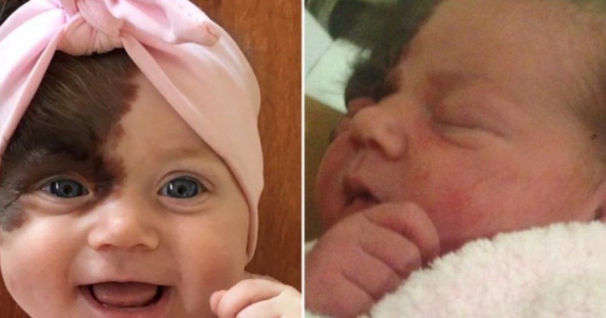 Baby Set To Undergo Seven Operations To Remove Hairy Birthmark Covering ...