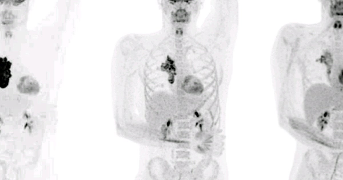 Scans Show Cancer Patient's Tumour Shrinking After Doctors Gave Him 12 ...