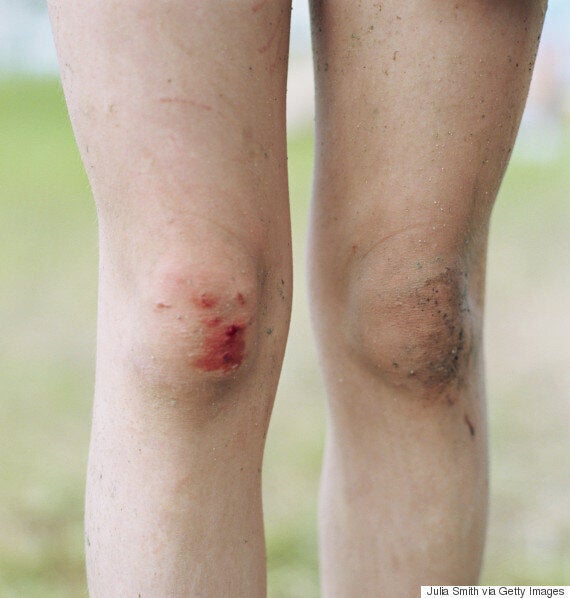 Congenital Insensitivity To Pain: Scientists Find Possible Cause For ...