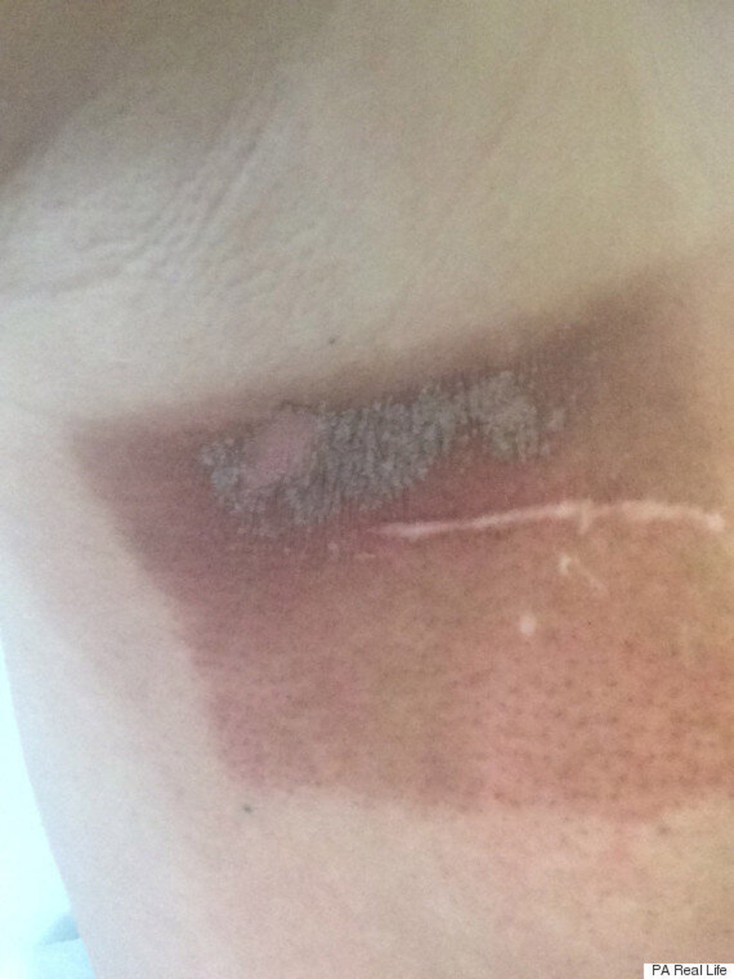 Breast Cancer Survivors Show Surgery Scars In Response To M&S And ...