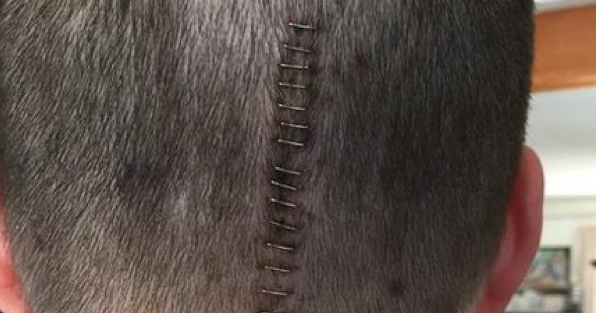 Man Sticks Zipper On Brain Cancer Surgery Scar 'To Show It's OK To ...