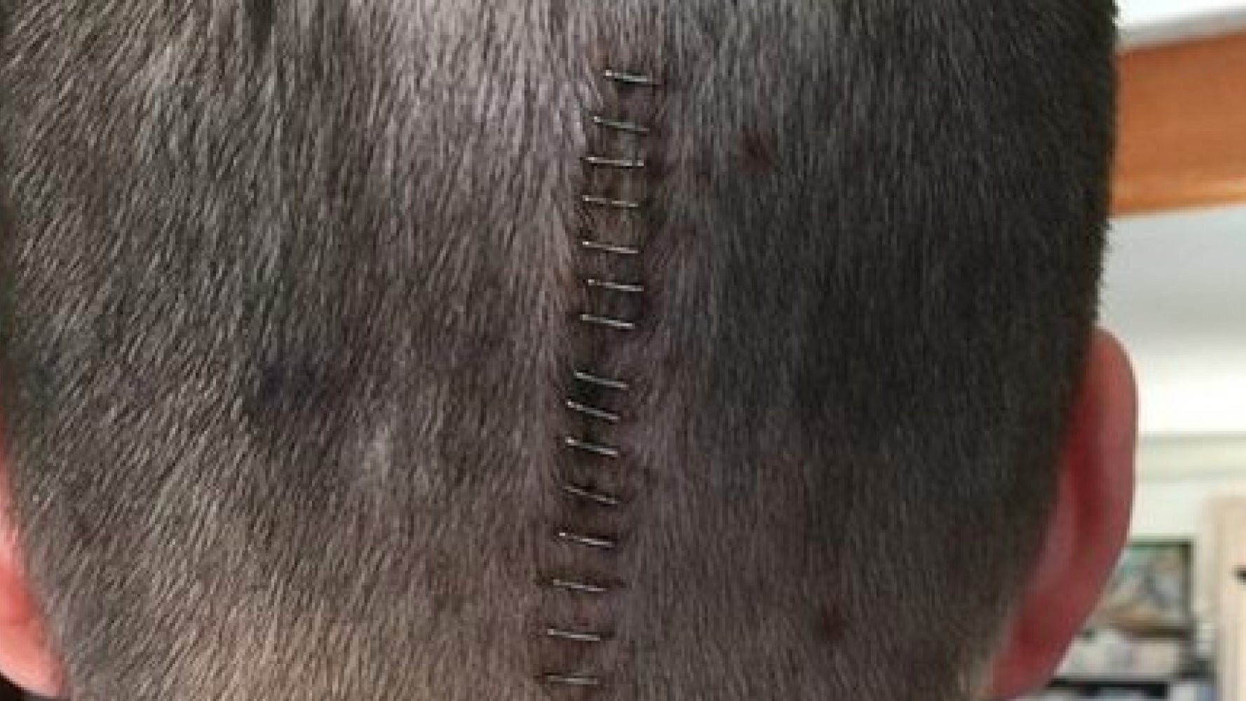 Man Sticks Zipper On Brain Cancer Surgery Scar 'To Show It's OK To ...